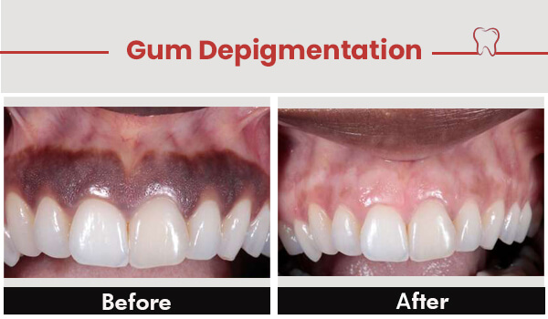 Best Gum Depigmentation Treatment in Lucknow