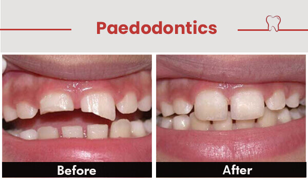 Kids Dental Treatments in Lucknow