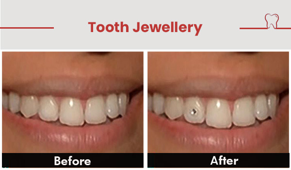 Dental Jewellery in Lucknow | Tooth Jewellery in Lucknow