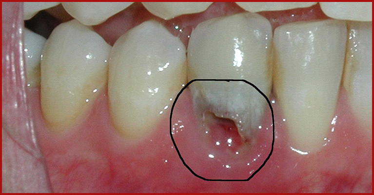 What is meant by Tooth Resorption (or) Dental Resorption? | DentaZone