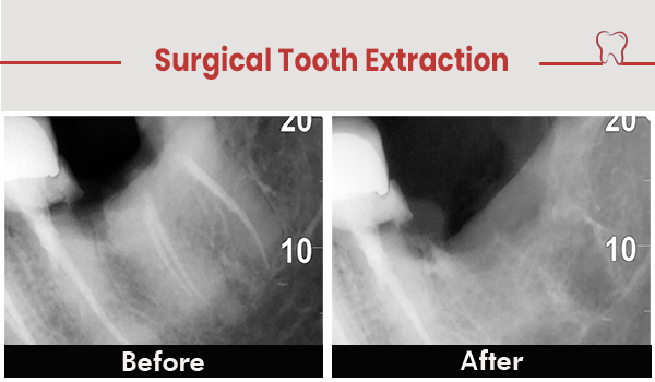 Tooth Extraction Doctors in Lucknow | Oral Surgery in Lucknow